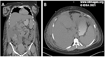 Infectious Disease Images - eMicrobes Digital Library - Cases