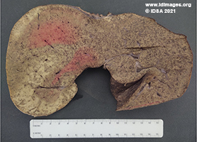 Infectious Disease Images - eMicrobes Digital Library - Cases