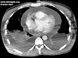 Infectious Disease Images - eMicrobes Digital Library - Cases