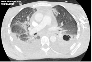 Infectious Disease Images - eMicrobes Digital Library - Cases