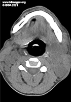 Infectious Disease Images - eMicrobes Digital Library - Cases