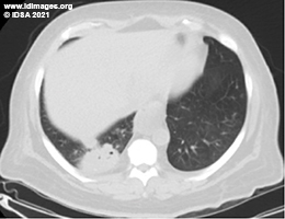 Infectious Disease Images - eMicrobes Digital Library - Cases