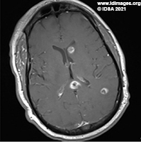 Infectious Disease Images - eMicrobes Digital Library - Cases