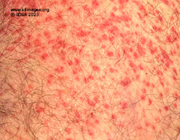 Infectious Disease Images - eMicrobes Digital Library - Cases