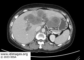 Infectious Disease Images - eMicrobes Digital Library - Cases