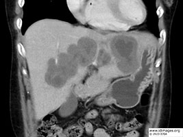 Infectious Disease Images - eMicrobes Digital Library - Cases