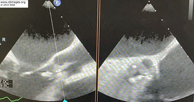 Infectious Disease Images - eMicrobes Digital Library - Cases